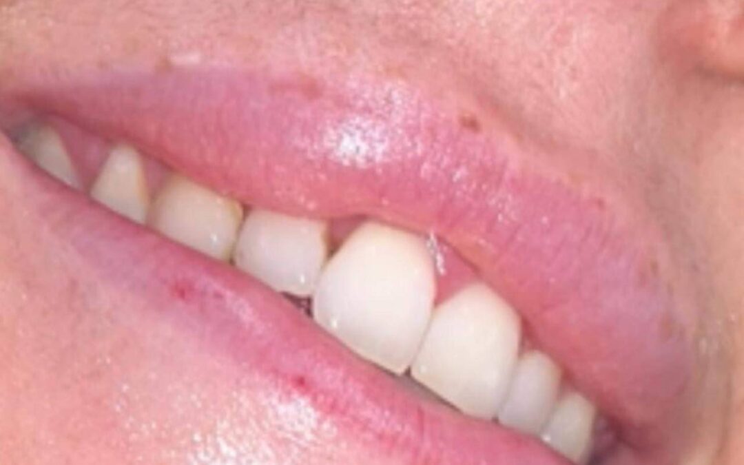 Dermal Filler Migration & How to Avoid it - Luxx International ...